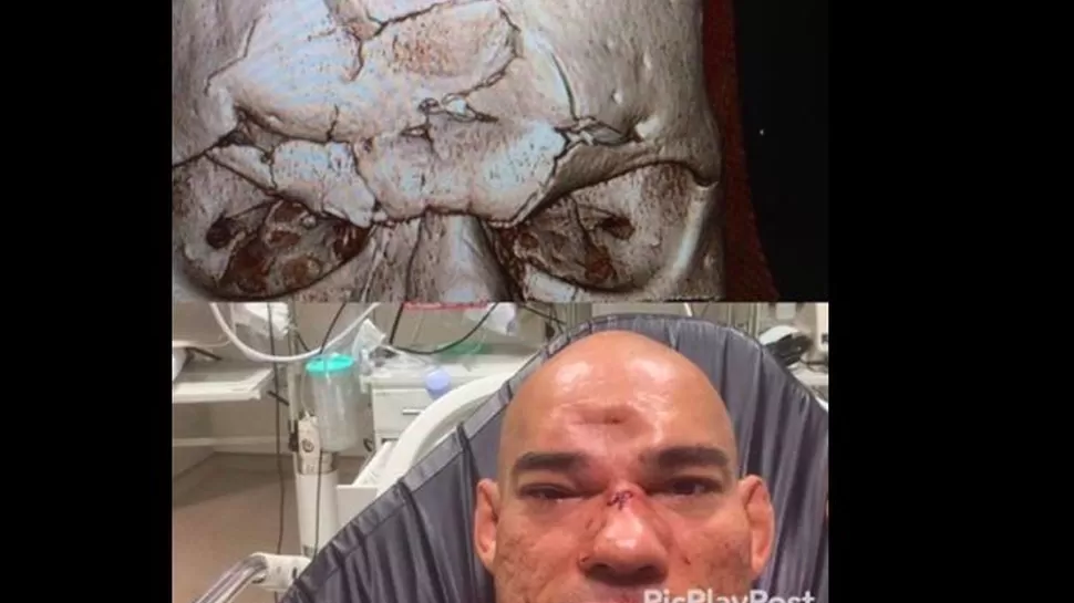 MMA: Page le rompió el cráneo a Evangelista Santos con este rodillazo ...