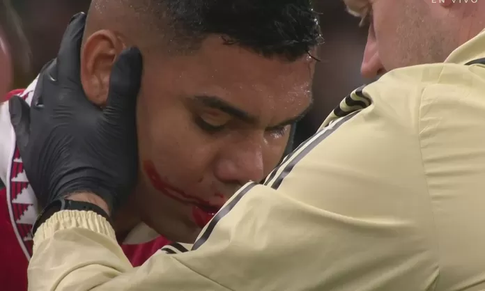 Sin querer queriendo... ¡le sacó sangre a Casemiro! | América Deportes Sin querer queriendo... ¡le sacó sangre a Casemiro! | América Deportes